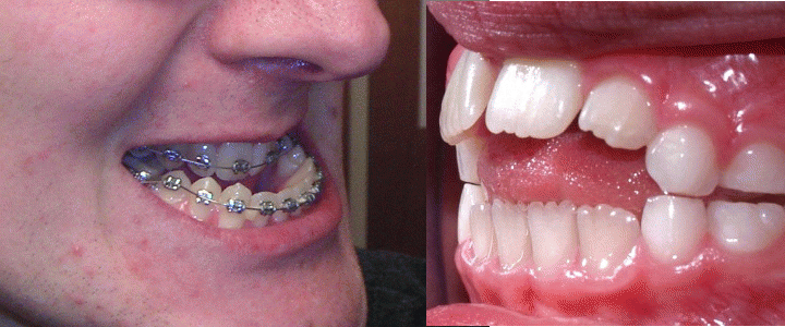 Προγναθισμός - Care.gr